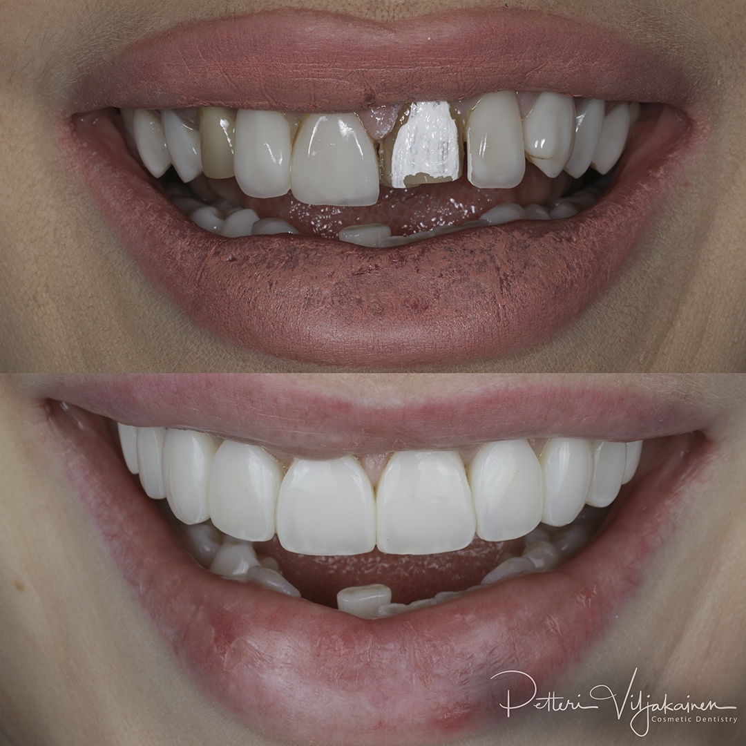 Composite Veneers